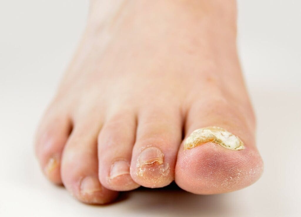 How to Cut Thick Toenails – Swissklip