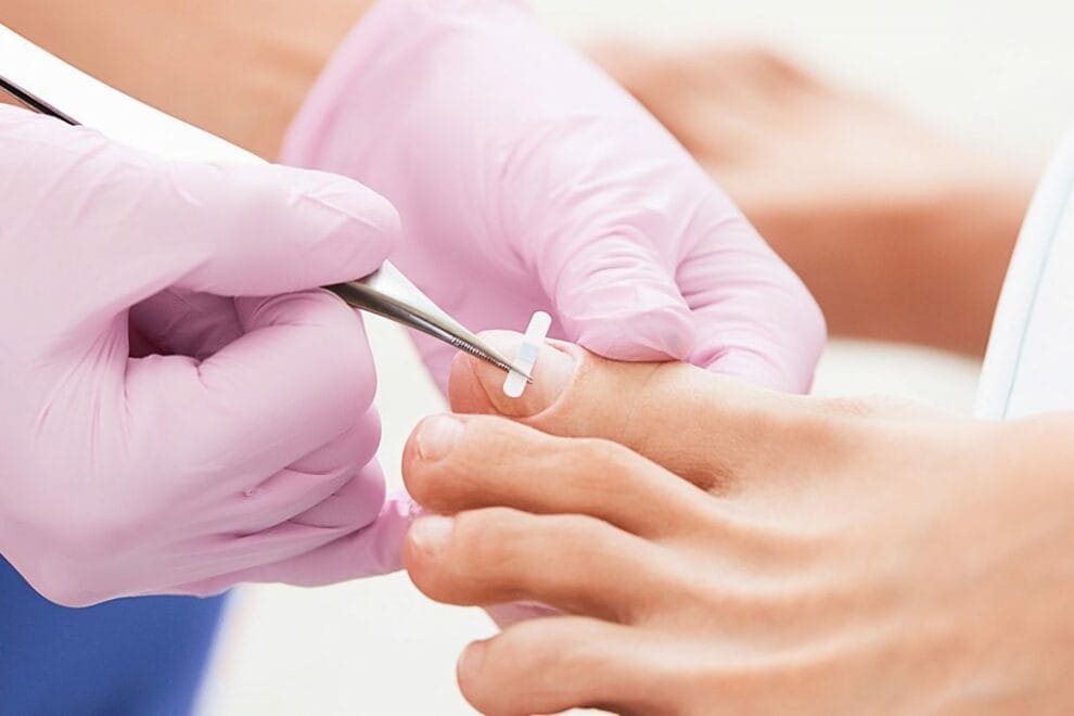 Non-surgical Ingrown Toenail Treatment - Swissklip