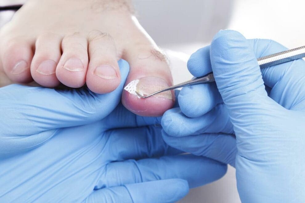 Will an Ingrown Toenail Eventually Grow Out on Its Own? - Swissklip