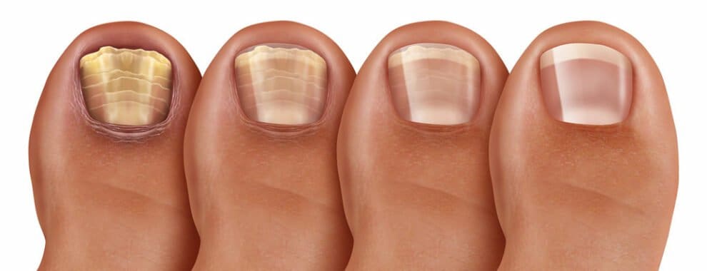 What Causes Thick Toenails? – Swissklip