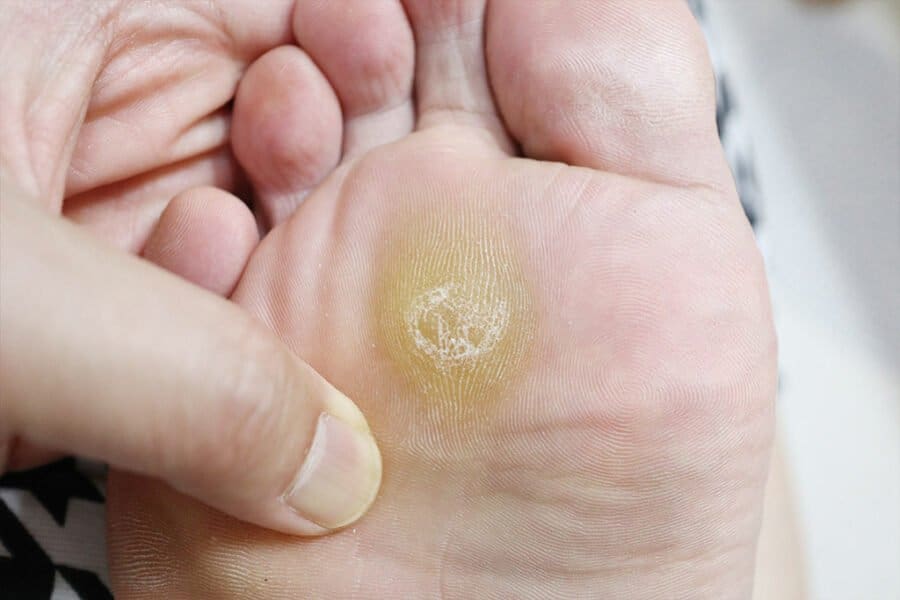 How to Get Rid of Calluses On Feet – Swissklip