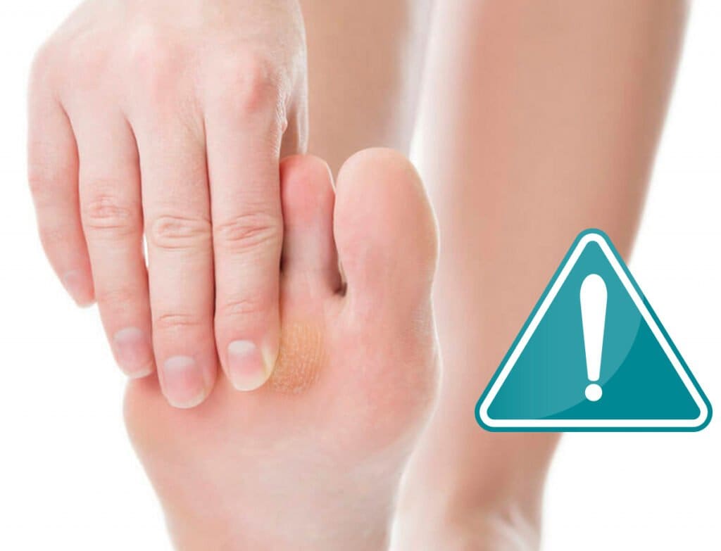 How to Get Rid of Calluses On Feet - Swissklip