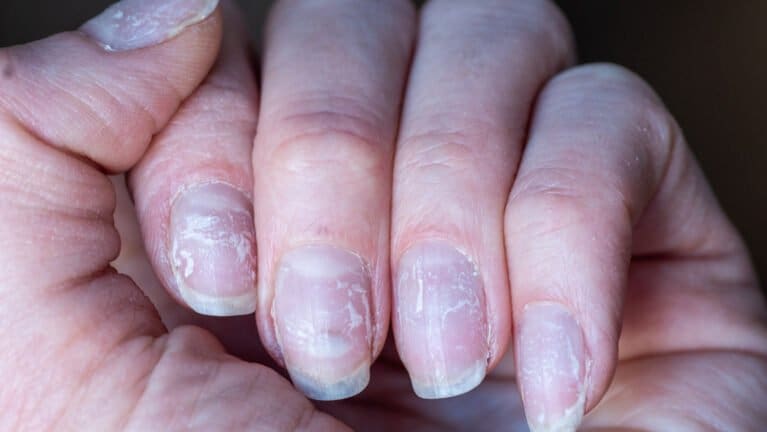 Why Are My Nails Peeling? - Swissklip