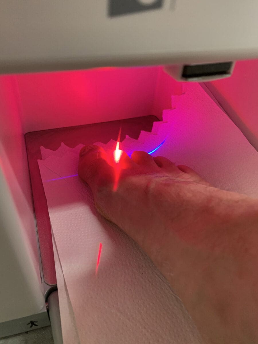 Pros and Cons of Laser Treatment for Toenail Fungus - Swissklip