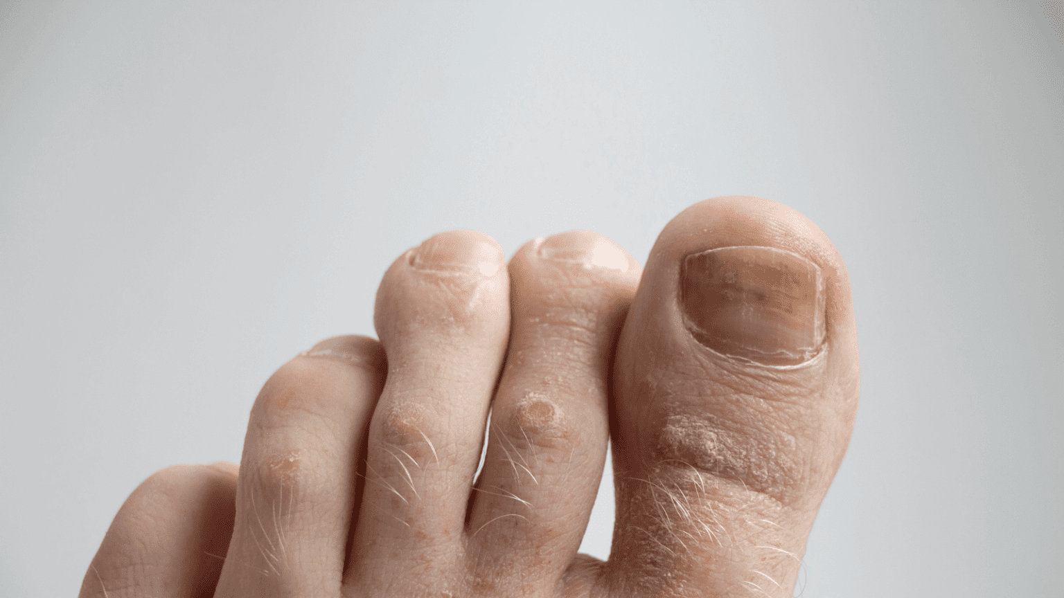 Nail mold vs Fungus: Causes, Differences, and Treatments